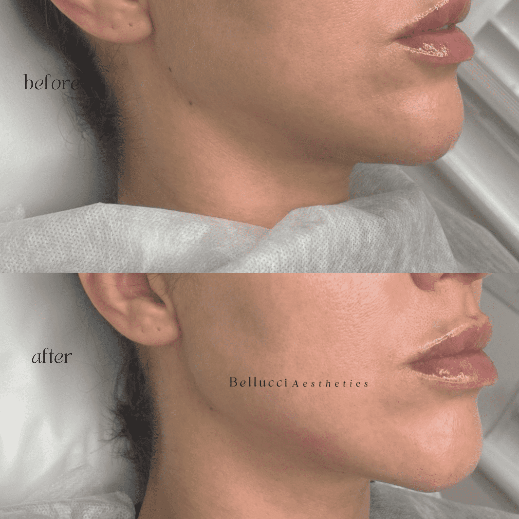 Jawline Fillers in West London