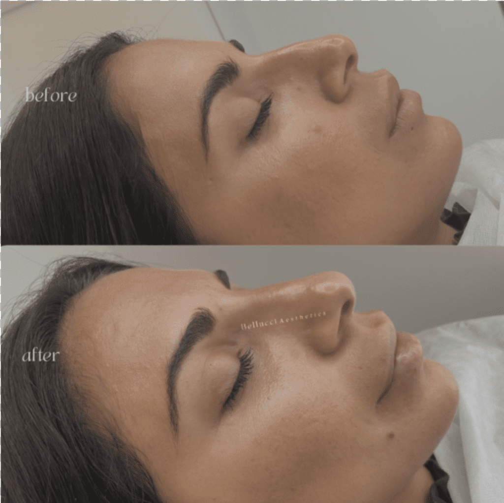 Non Surgical Rhinoplasty without getting under the knife